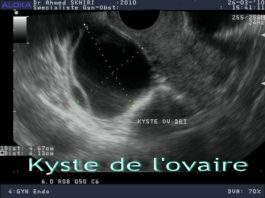 Kyste de l’ovaire - Dr Ahmed SKHIRI